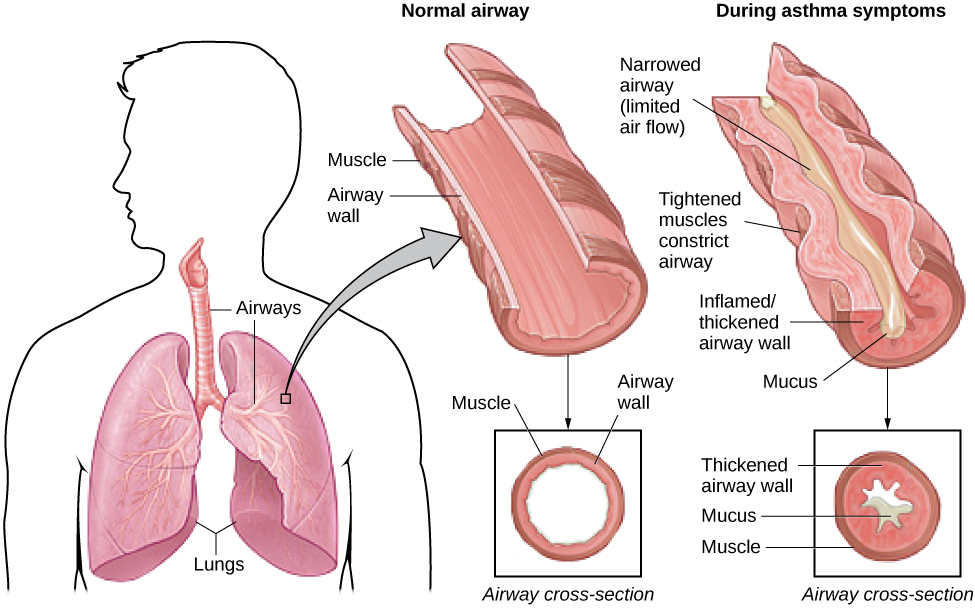 Stress And Asthma Introduction To Psychology