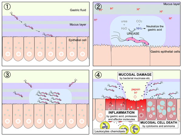Peptic Ulcers | Nutrition | Study Guides