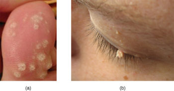 Viral Infections of the Skin and Eyes | Microbiology