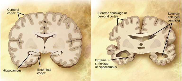 Nervous System Disorders | Biology for Majors II
