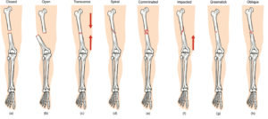 Fractures: Bone Repair | Anatomy and Physiology I