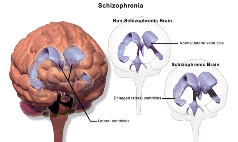 Schizophrenia and Dissociative Disorders | Introduction to Psychology