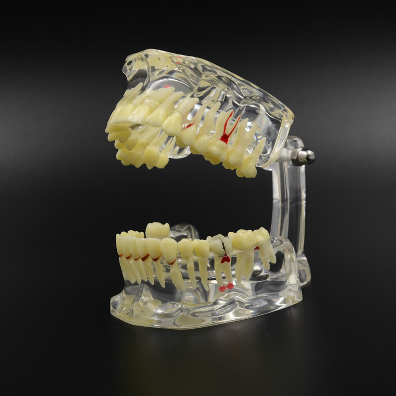 Dental Study Tooth Model Transparent Adult Pathological Tooth Model ...
