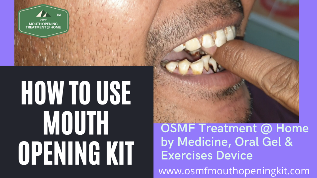 Osmf Mouth Opening treatment Kit Releases Video Showing How to Use the ...