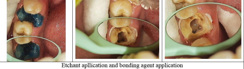 Complexities in endodontics: A case series - IJCE
