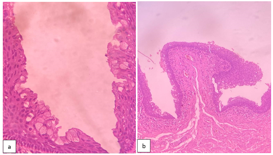 Zoons Balanitis With Mucinous Metaplasia A Case Report Rodolfo E.
