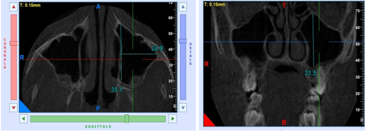 Evaluation Of Maxillary Sinus Dimensions And Volume In Different