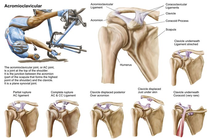 What is an AC joint injury, and why is it so common in contact sports ...