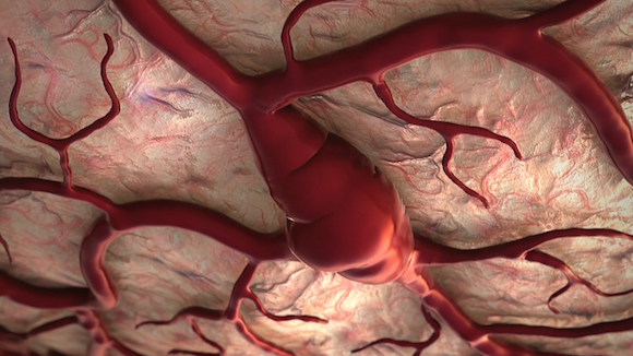 Her aneurysm burst during a Teams call