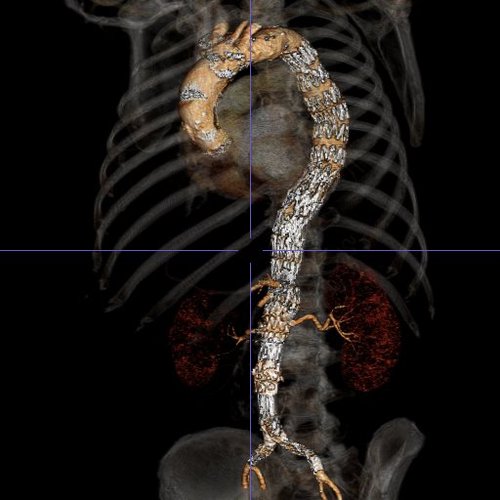 'One of the luckiest guys': Charlie's abdominal aortic aneurysm repair ...
