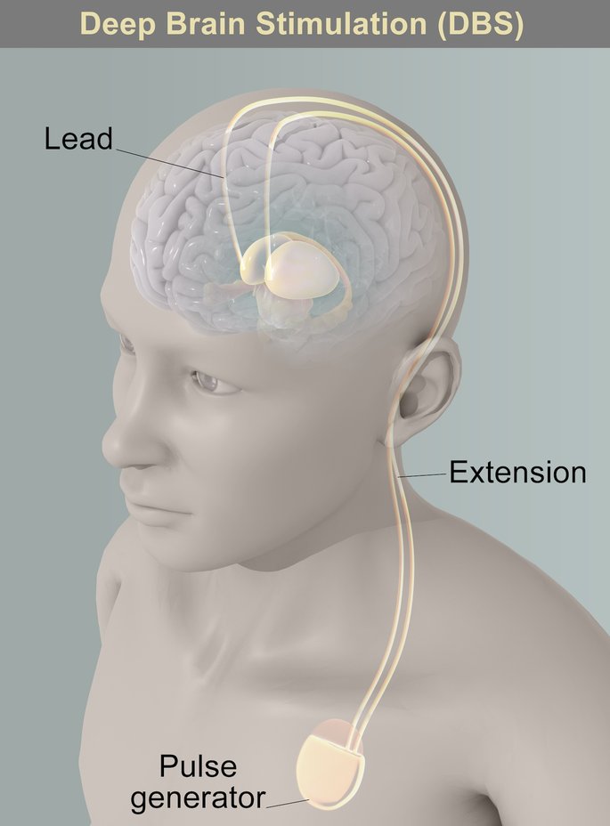 Deep Brain Stimulation | Conditions & Treatments | UT Southwestern ...