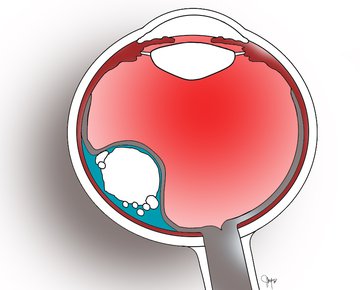 Intra-arterial chemotherapy delivers most precise treatment for ...