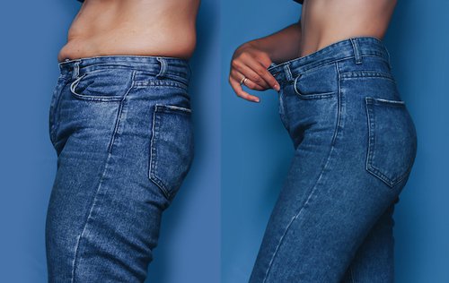 Advances in liposuction create safer, more effective body-contouring ...