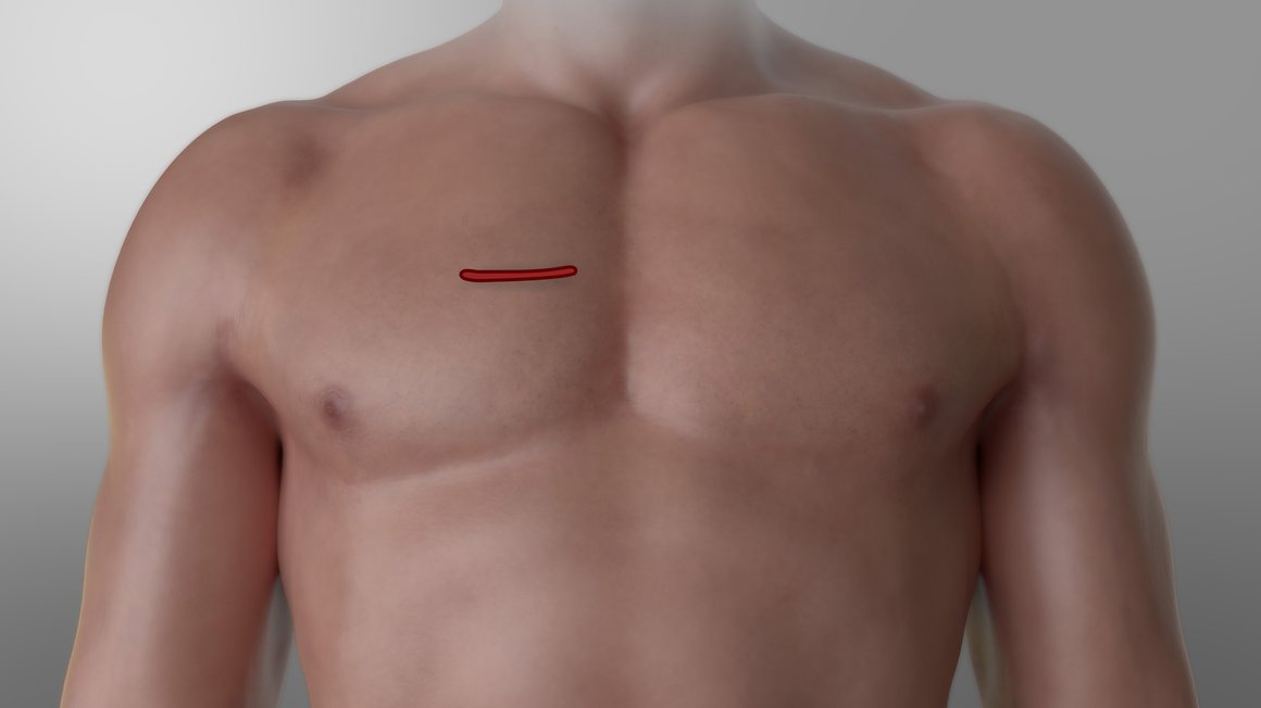 Minimally Invasive Heart Valve Surgery | Conditions & Treatments | UT ...