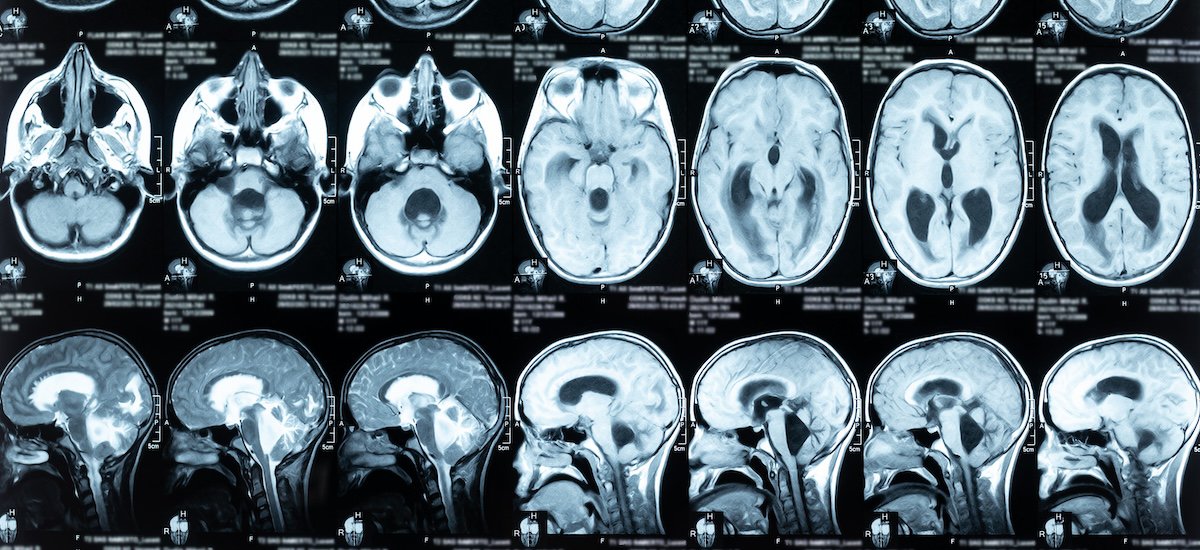 Normal Pressure Hydrocephalus (NPH) | Peter O'Donnell Jr. Brain ...