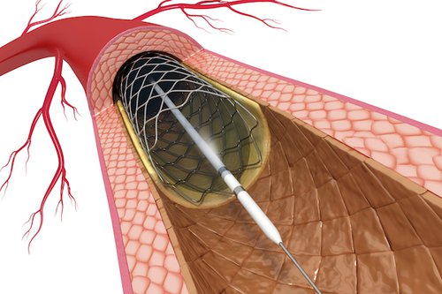 How PCI stenting can reduce chest pain and heart attack damage ...