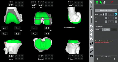 Robotic knee replacement surgery enhances precision, personalization ...