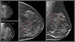 A big step for breast health in Texas: 3-D mammograms now covered by ...