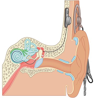 Cochlear implants for hearing loss: Myths vs. reality | ENT ...