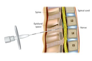 9 myths about epidurals – debunked | Your Pregnancy Matters | UT ...