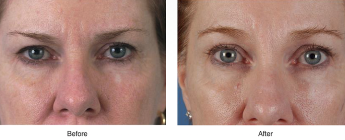 Eye-catching options to rejuvenate your eyelids | Aging | Plastic ...