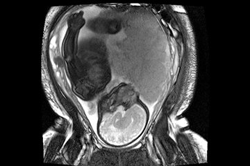 What you need to know if you are sent for a fetal MRI | Your Pregnancy ...