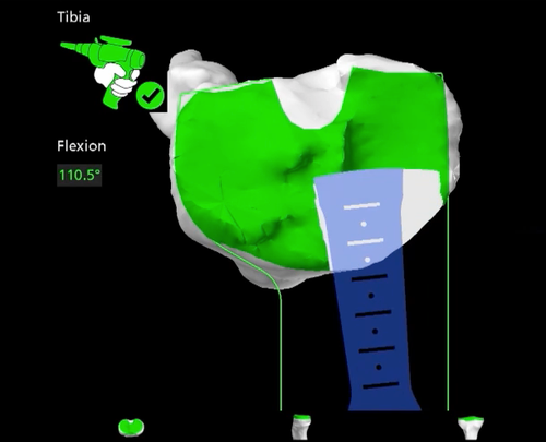 Robotic knee replacement surgery enhances precision, personalization ...