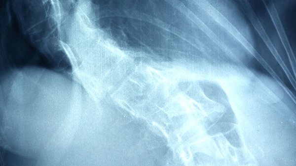 Spinal Deformities | Spine Center | Condition | UT Southwestern Medical ...