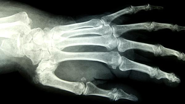 Traumatic Hand and Upper Extremity Injuries | Condition | UT ...