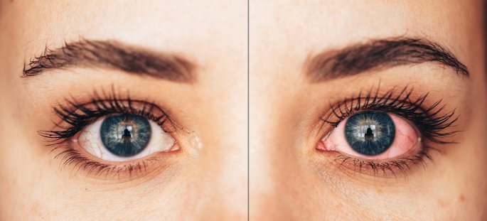 How to prevent infections after eye surgery | Eyes and Vision ...