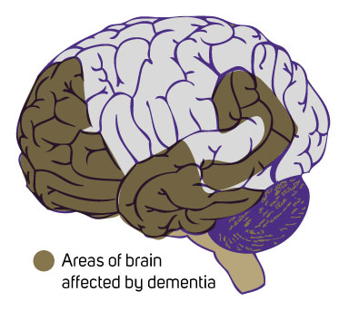 Deconstructing dementia | Be Boundless